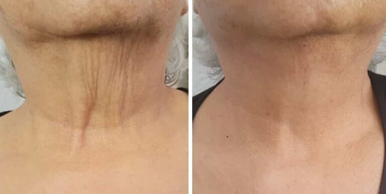 Endolifting Advanced Machine FDA approved