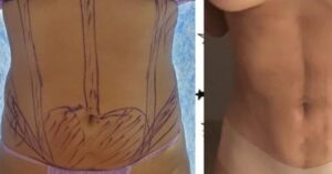 Endolifting Advanced Machine FDA approved