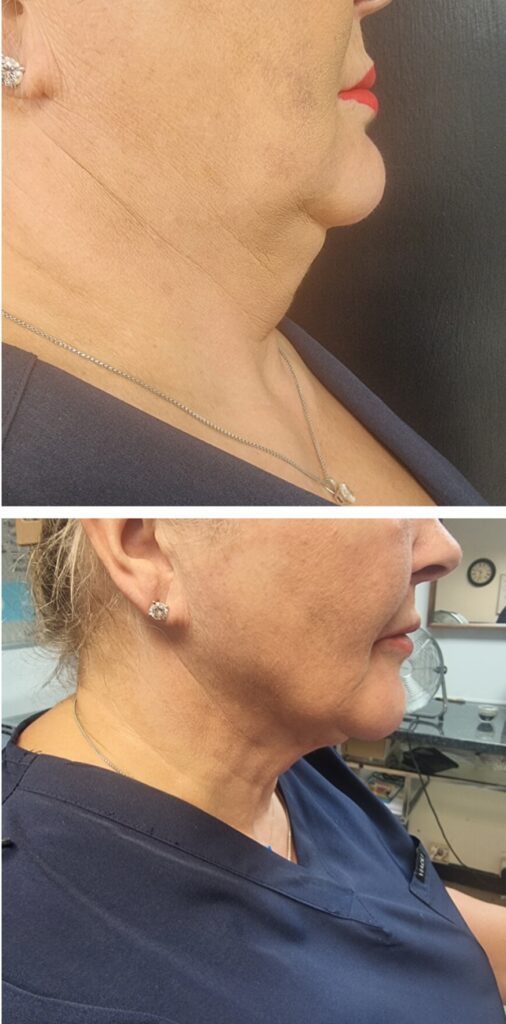 Endolifting Fibre Laser Course