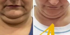 Endolifting Advanced Machine FDA approved