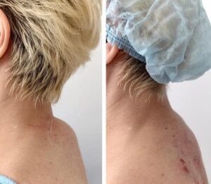 Endolifting Advanced Machine FDA approved